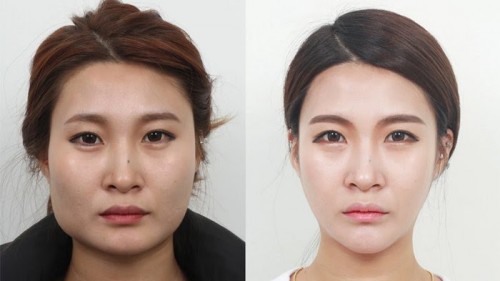 Tertarik Operasi Plastik, Ini Deretan Harga di Area Wajah - Malang Times