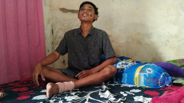 Saguwanto, Remaja Korban Selamat Tragedi Kanjuruhan Alami Patah Tulang ...