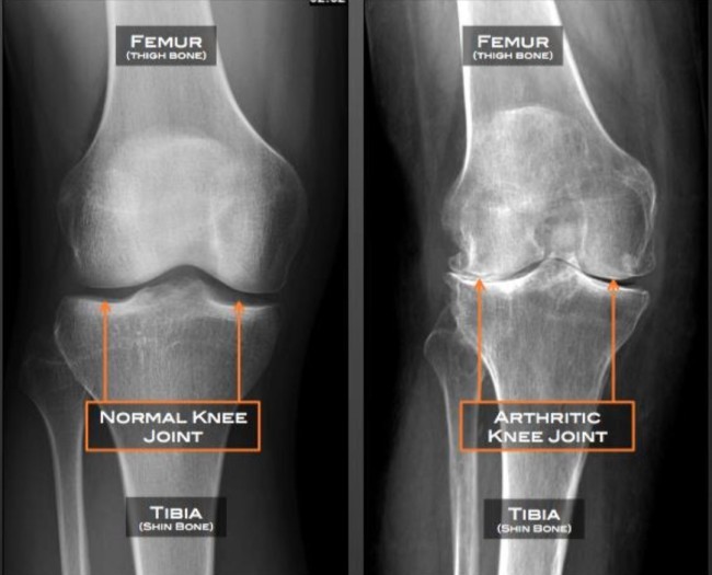 Tangkal Pengapuran Sendi dengan 5 Tips dari Pakar Tulang